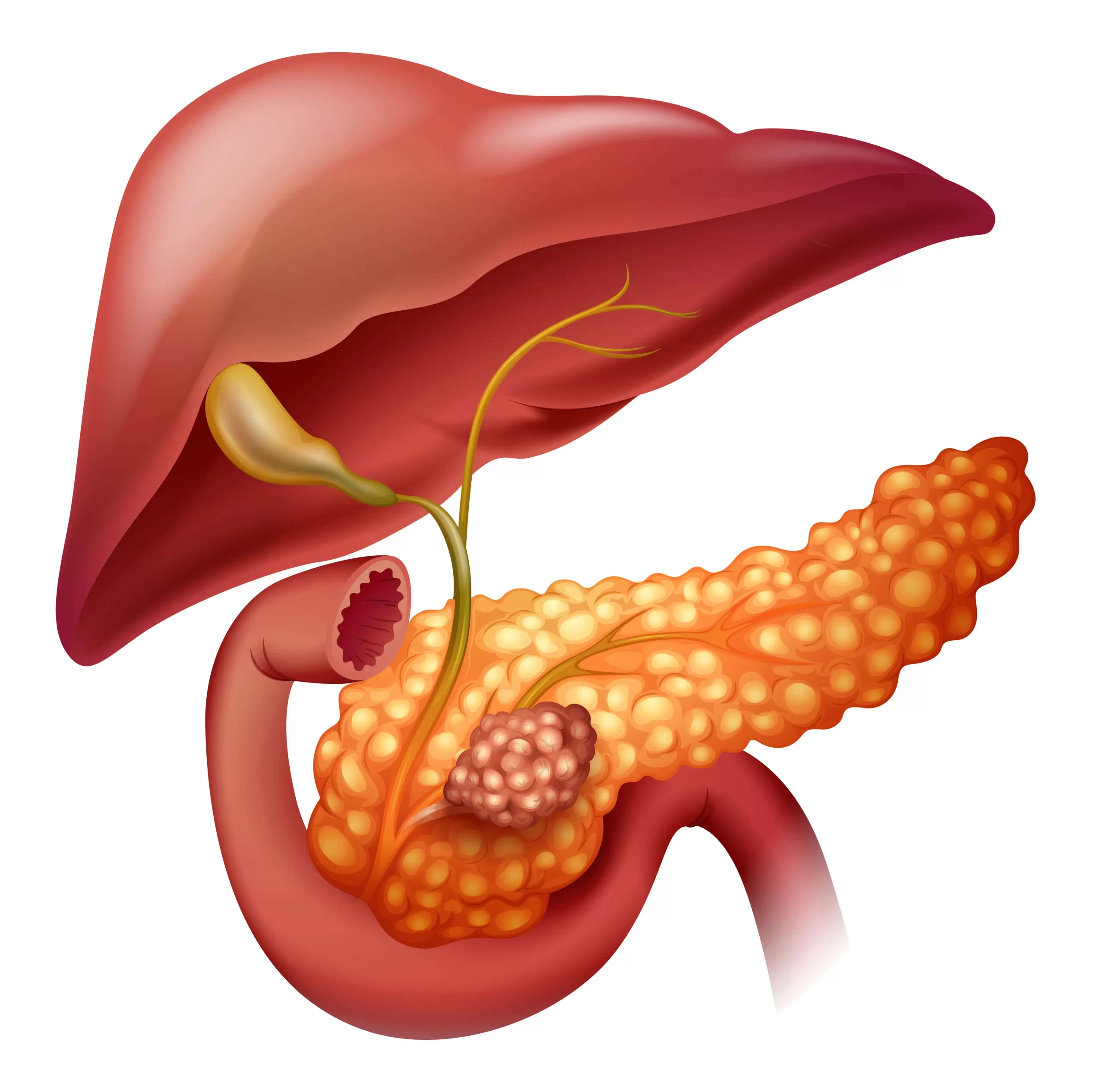 Pancreatic Cancer Awareness: Early Detection and Prevention